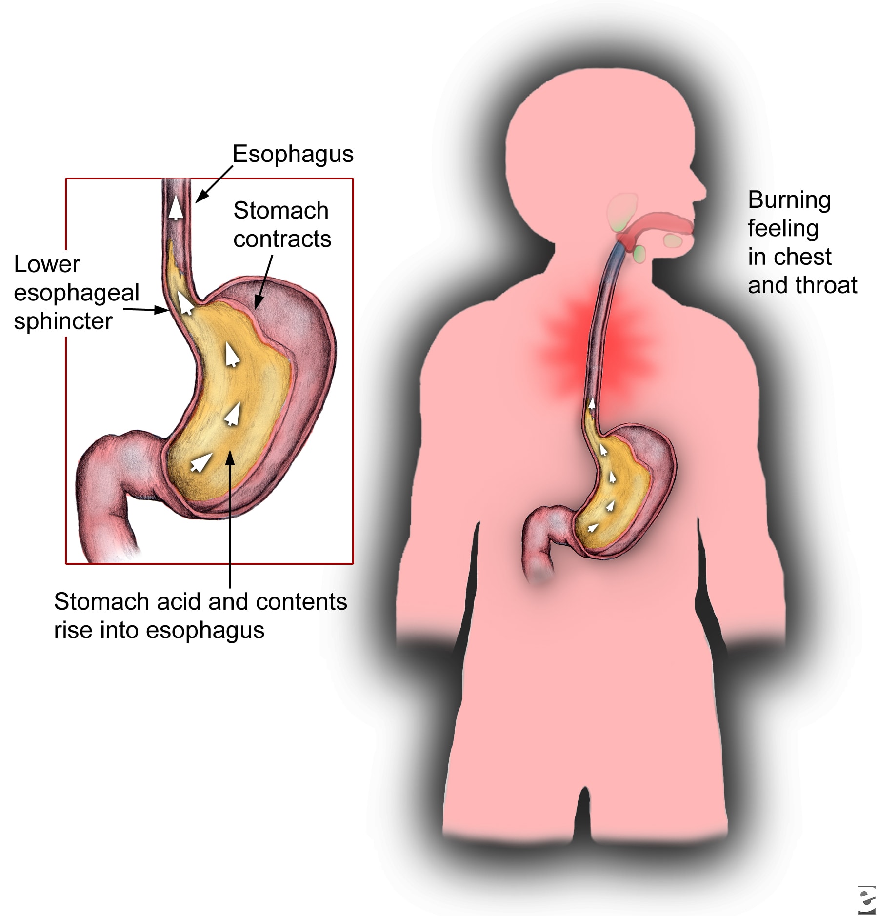 Punca dan Rawatan Pedih Ulu Hati Ketika Hamil - Tips Kesihatan